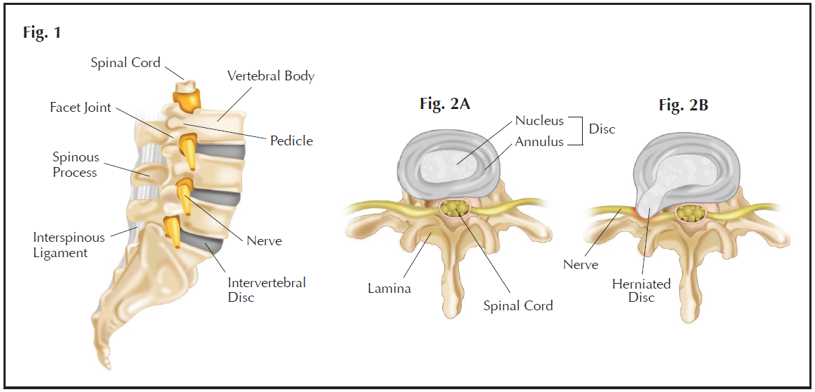 Slipped Disc FAQs Spine Surgery Health Information Hong Kong Slipped Disc FAQs Spine Surgery Health Information Hong Kong